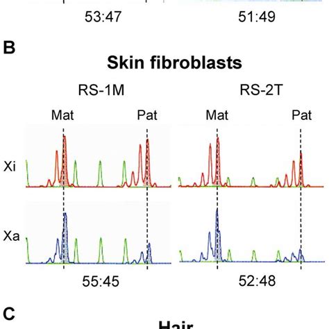 X Chromosome Inactivation Analyses Xi X Inactivation Pattern Based On
