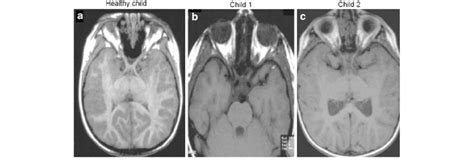 Mri Structures Of Optic Nerves Chiasm And Optic Tracts Are Presented