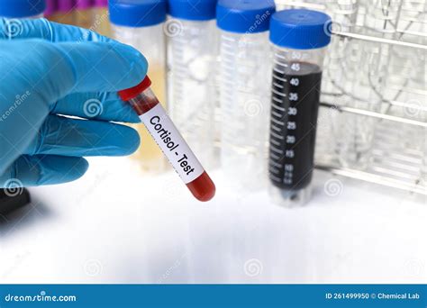 Cortisol Lab Test Tube Color At Judy Moore Blog