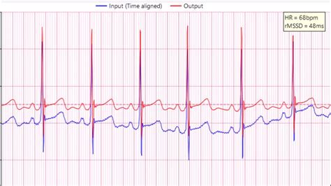 Dr Sanjeev Sarpal On Linkedin Algorithms Arm Ecg Biomedical Fda