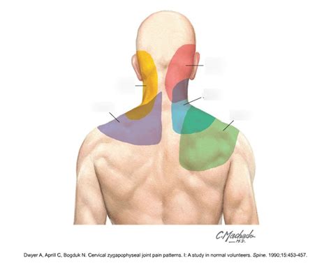 Cervical Facet Joint Referral Pattern Diagram Quizlet