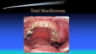 Maxillectomy And Craniofacial Resection Pptx