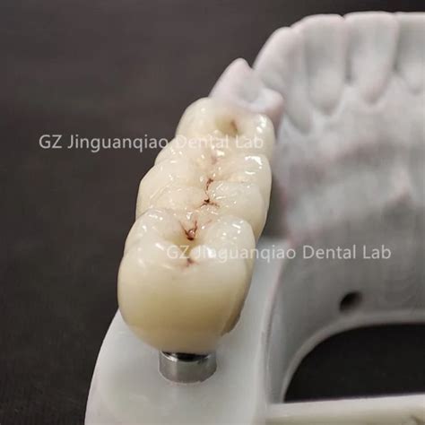 Three Unit Bridge Implant Cement Screwed Dental Crown And Bridge With