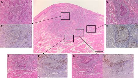 Squamous Cell Carcinoma Histology Labeled