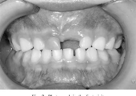 Figure 1 From Management Of The Malposition Tooth That Was Caused By