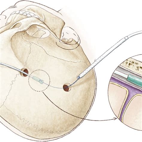Intraparenchymal Misplacement Of A Subdural Drain As Seen On Axial