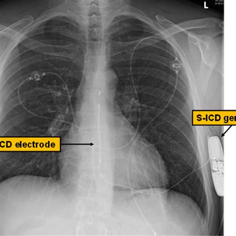 Chest X Ray Of A Male Patient After S ICD Implantation The Generator Download Scientific