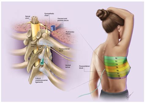 Paravertebral Blocks In Implant Based Breast Reconstruction Do Not
