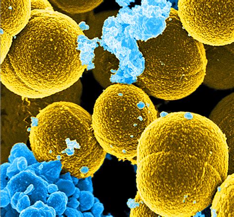 Could Inoculum Effect In Staph Endocarditis Affect Choice Of Antibiotic