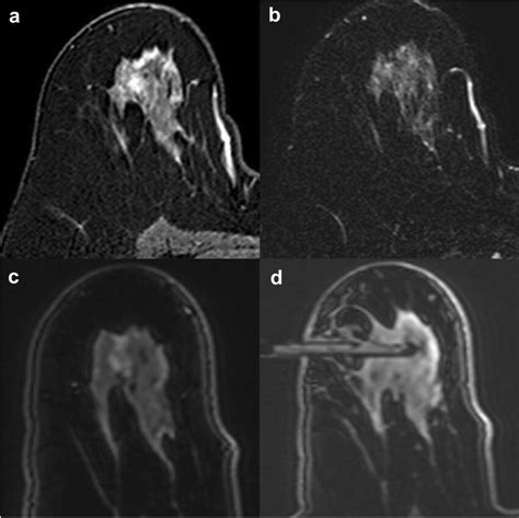 A Axial Fat Saturated Post Contrast Breast Mri Image Of A 57 Year Old