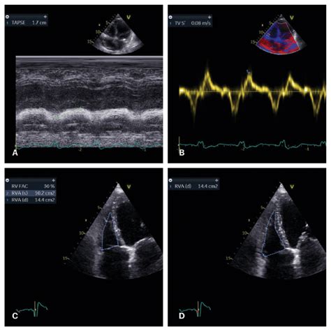 parameters of rv systolic function a tricuspid annular systolic