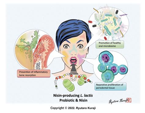 The Many Healing Faces Of Nisin Nisin And Its Probiotic Prevent Inflammatory Bone Loss While