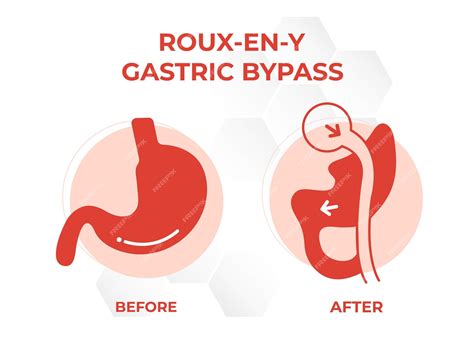 Premium Vector Gastric Bypass Rny Weight Loss Surgery Vector