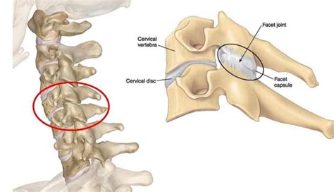 Cervical Facet Joint Pain Complete Physio
