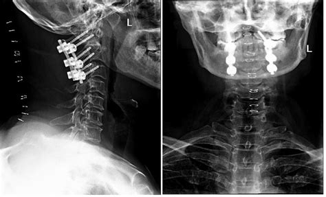 Frontiers Os Odontoideum Associated With A Retro Odontoid Cyst