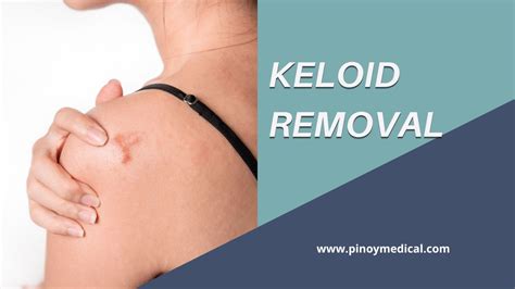 Keloid Removal Price In The Philippines 2026 — Pinoymedical