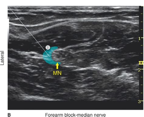 Ultrasound Guided Forearm Blocks Hadzics Peripheral Nerve Blocks And