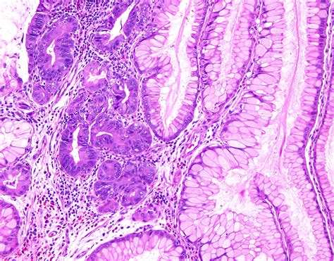 Hyperplastic Polyp Pathology Outlines Clinical Pathology Intestinal