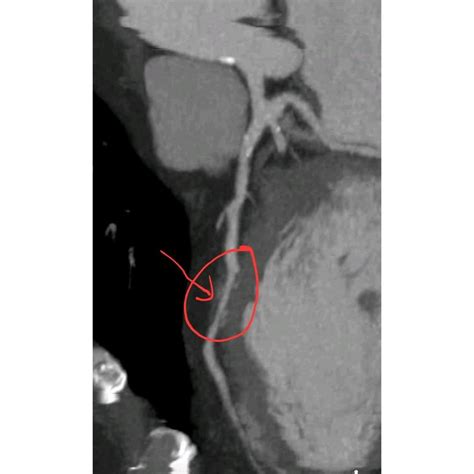 Ebrahim A Dorgham Ead On Linkedin Mid Lad Myocardial Bridge Mohamed Gibreel Thanks For