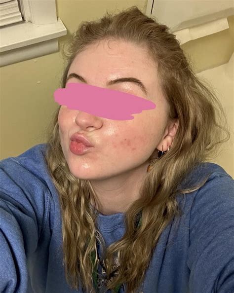 Before Accutane Vs 5 Months Raccutane Before Accutane Vs 5 Months Raccutane