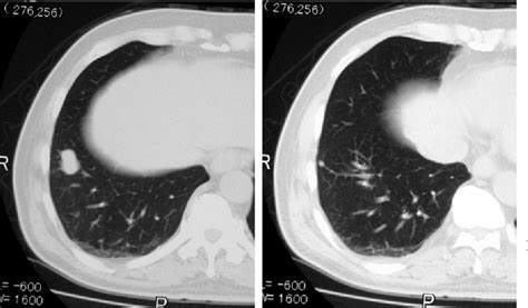 Figure 1 From Subpleural Intrapulmonary Lymph Node Metastasis From Colorectal Cancer Semantic