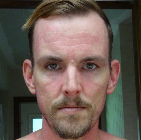 Cure Psoriasis Naturally How To Heal Psoriasis At Home