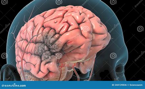 Brain Bleed Stoppage Neon Glow Icon Illustration 271272752