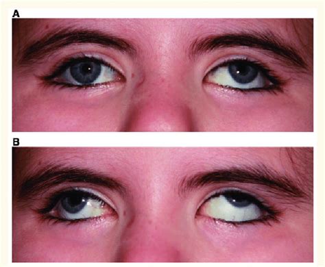 Lateral Gaze