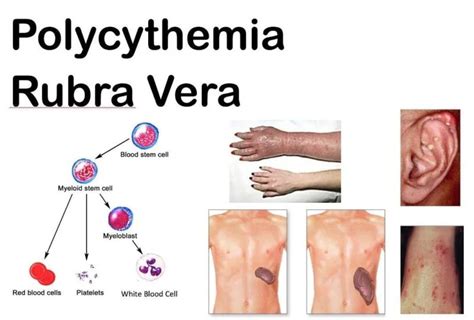 Polycythemia Vera Symptoms Causes Stages Diagnosis And Treatment