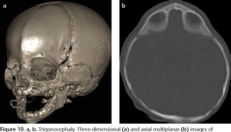 Trigonocephaly Ct Scan