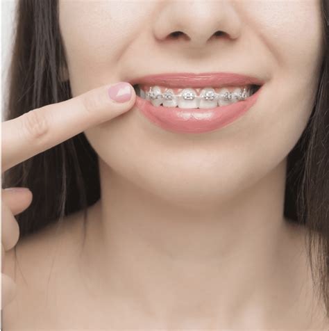 Rubber Bands In Braces What Are Their Functions