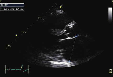 Left Parasternal Long Axis View Shows Severely Enlarged Left Atrium At