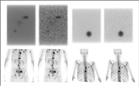 Figure 1 From Denoising Of Scintillation Camera Images Using A Deep Convolutional Neural Network