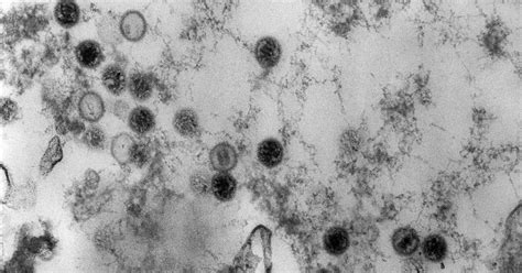 A Groundbreaking Finding On Multiple Sclerosis Is Dividing Scientists