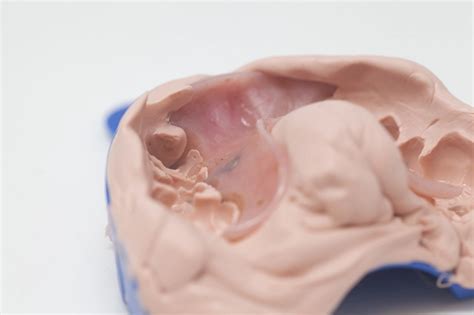 New Crown Under Existing Partial Denture Workflow Rdl Russellville Dental Lab