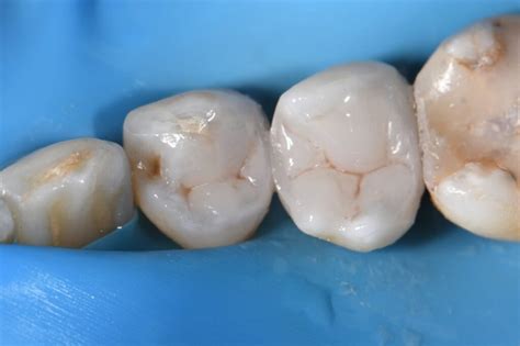 matrix in matrix assembly for complex dental fillings matrix in matrix