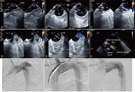 Transesophageal Echocardiographic Tee And Angiographic Findings In