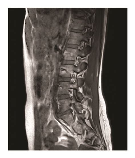 Vertebrae Recognition Using Cascade Of Boosted Classifiers Based On