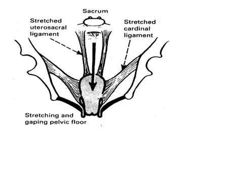 Uterineprolapse 130223183535 Phpapp02pdf