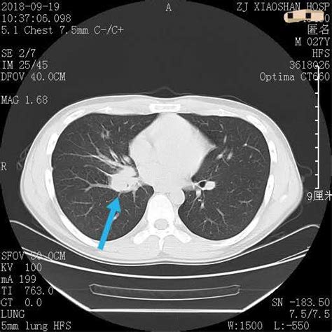 杭州27岁小伙每天抽烟三四包患肺癌晚期，医生：吸烟为主因 知乎