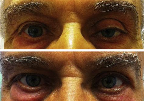 Figure 1 From Evaluation Of Levator Function For Efficacy Of Minimally Invasive And Standard