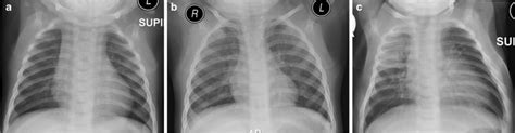 Anteroposterior Chest Radiographs Cxr Show The World Health Download Scientific Diagram
