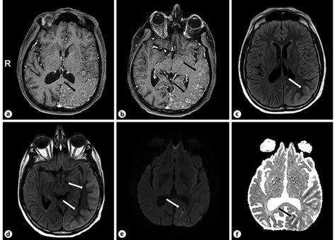 Pretreatment Brain Magnetic Resonance Images A B Cortical Gyriform Download Scientific