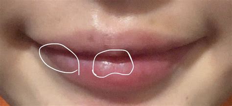 의사에게 물어보세요 입술필러 맞은지 1 강남언니 1등 성형수술and피부시술 정보앱