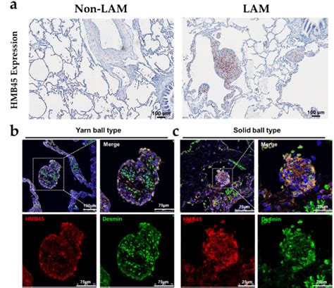 Histological Appearance Of Lymphangioleiomyomatosis Lam A