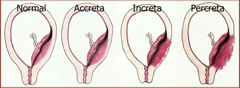 Placenta Previa — Taming The Sru