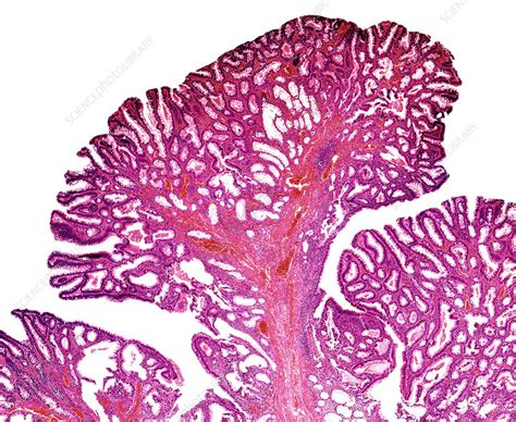 Hereditary Mixed Polyposis Syndrome Light Micrograph Stock Image C053 8931 Science Photo