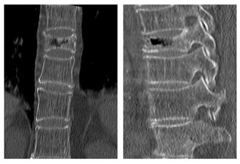 Development And Internal Validation Of Supervised Machine Learning Algorithm For Predicting The