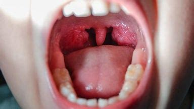 Amigdalitis En Niños ¿cómo Tratarla Mejor Con Salud