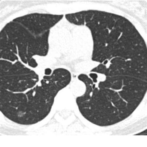 A 49 Year Old Woman With Subsolid Nodule Growth After Longterm